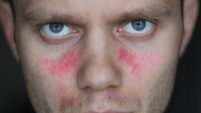 Lupus Symptoms Checklist: Spot the Signs Early | PureVital – Healthy ...